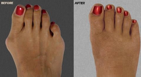 Silicone Hammer Toe Corrector – Tegooe