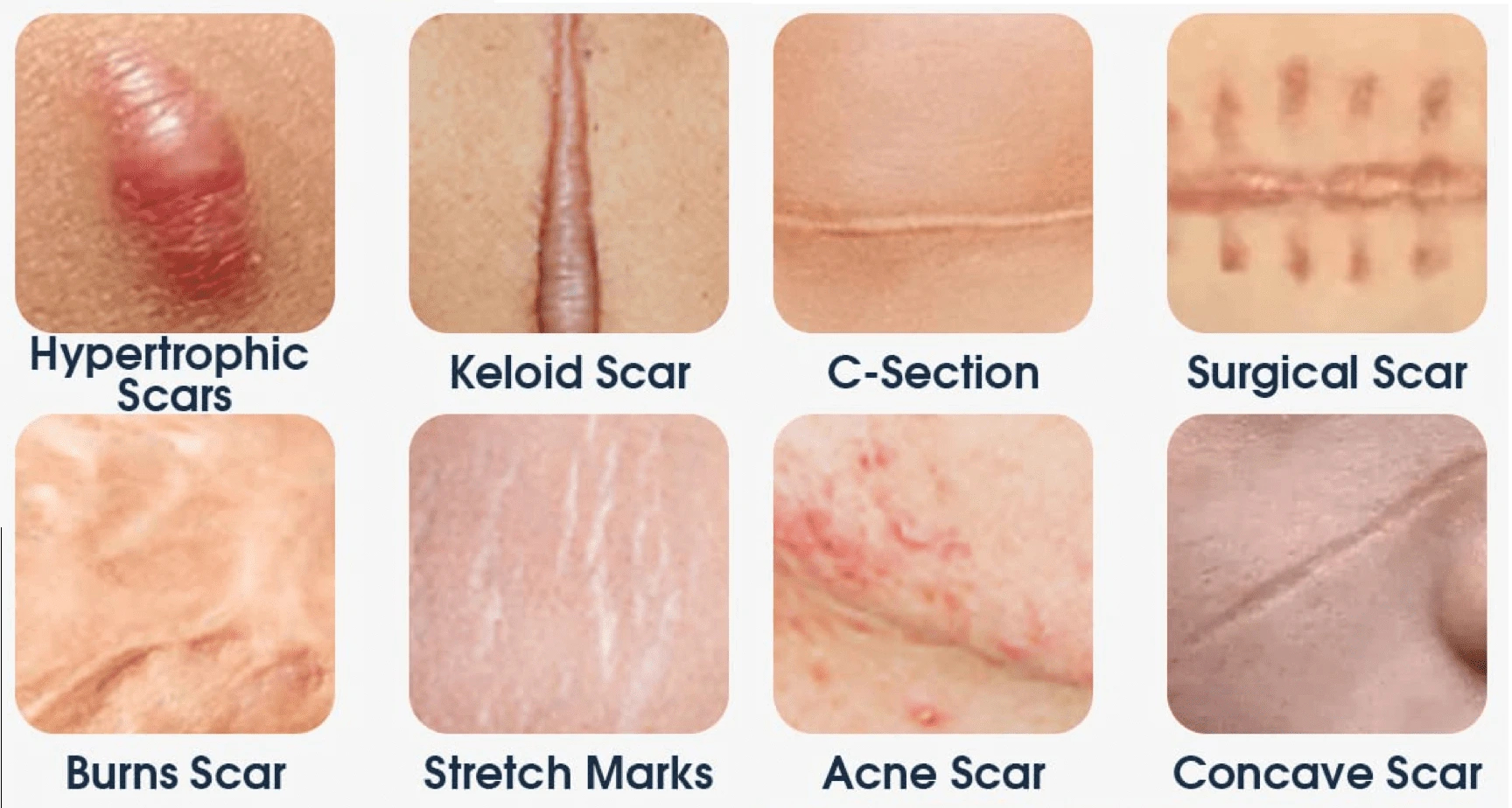 Can Red Light Really Fade Scars?